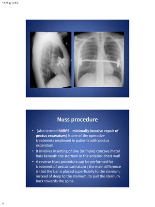 Pectus excavatum | PDF