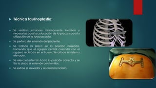 Pectus excavatum | PDF