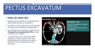 Pectus excavatum | PPTX