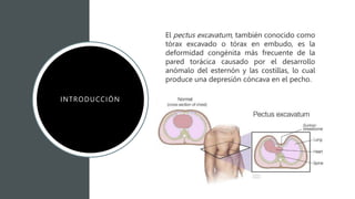 Pectus excavatum.pptx