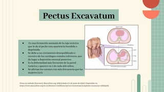 Pectus Excavatum | PDF