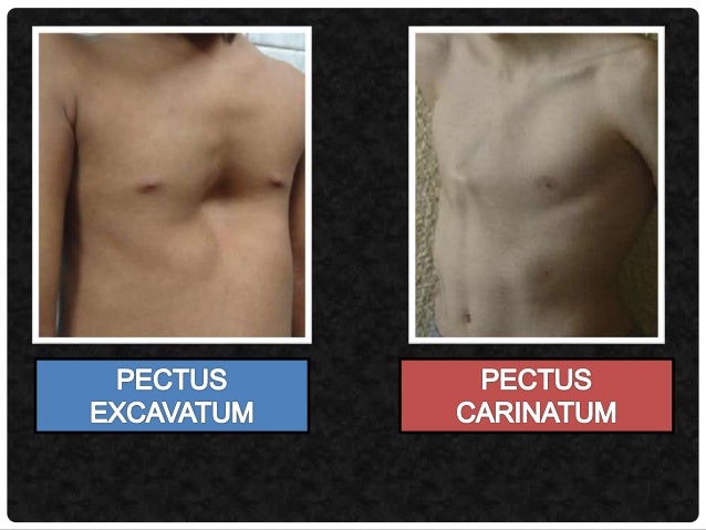 Pectus excavatum y pectus carinatum