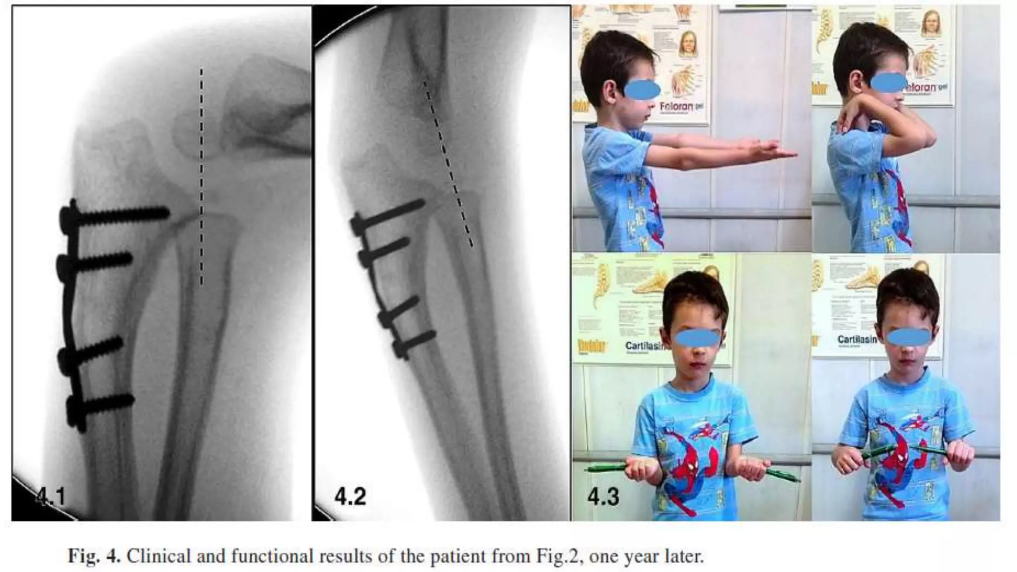 Pediatric Radial head dislocation | PPTX