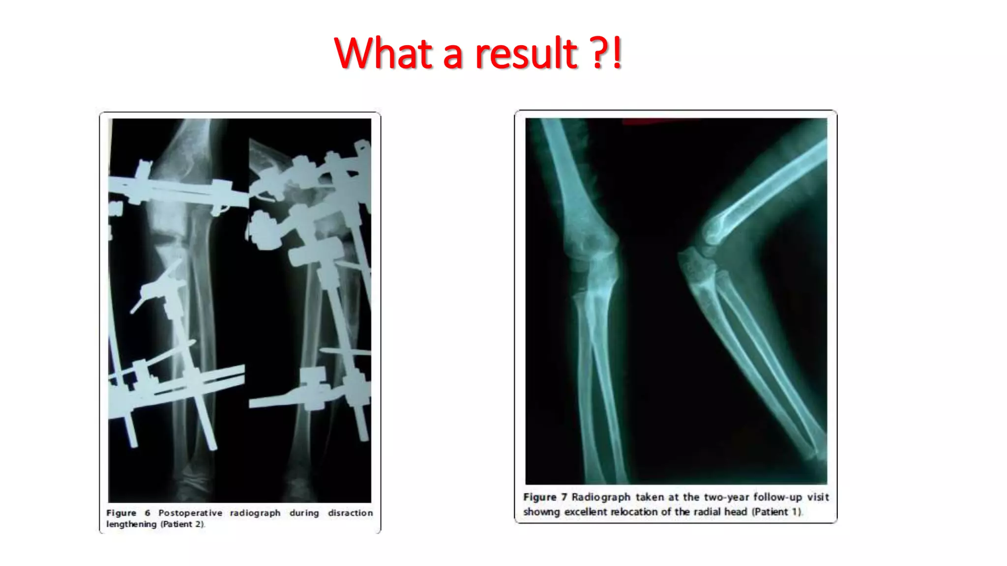 Pediatric Radial head dislocation | PPTX