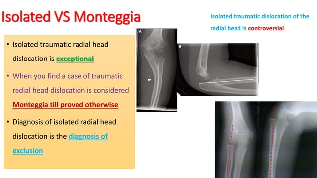 Pediatric Radial head dislocation | PPTX