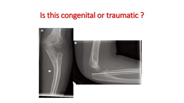 Pediatric Radial head dislocation | PPTX