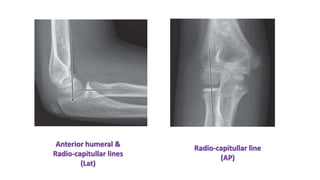 Pediatric Radial head dislocation | PPTX