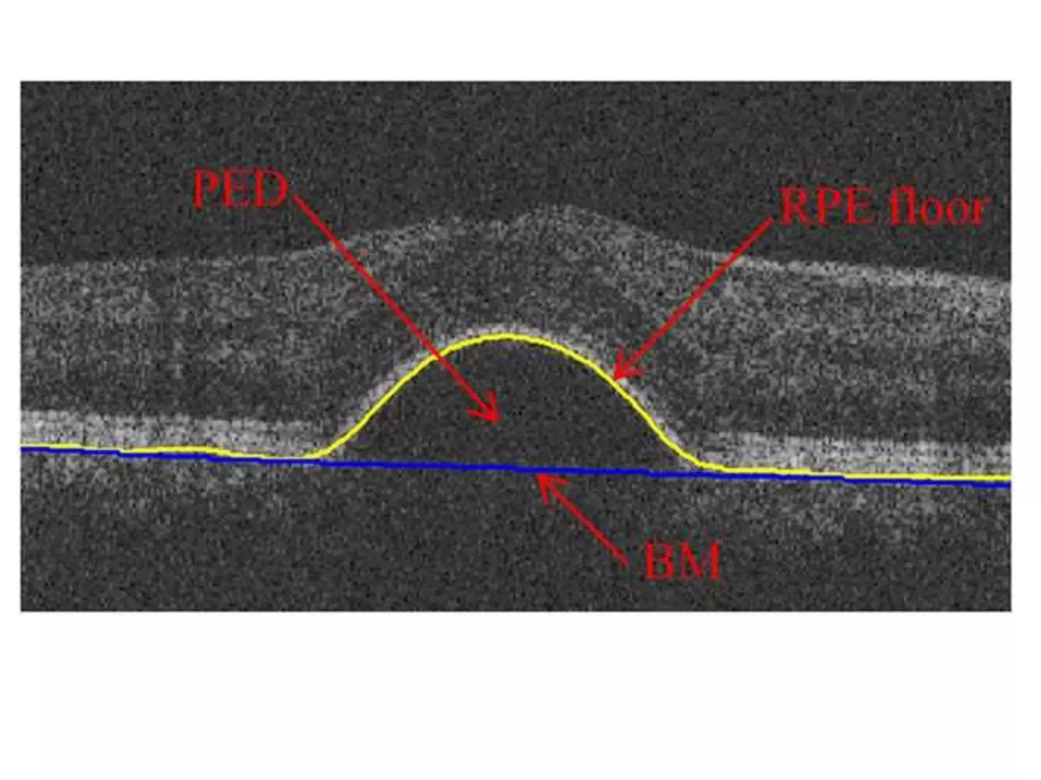 Pigment epithelial detachment (PED) | PPTX
