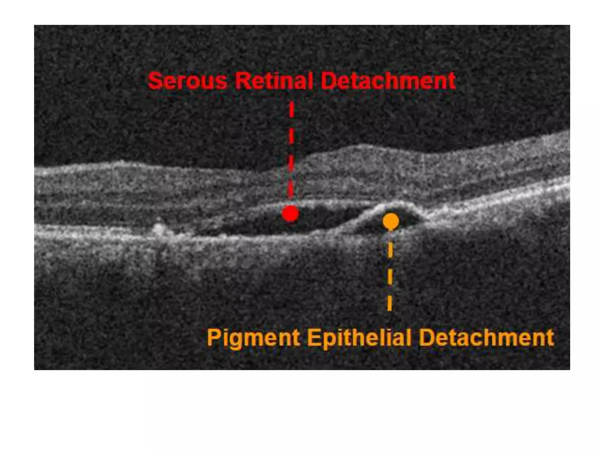Pigment epithelial detachment (PED) | PPTX