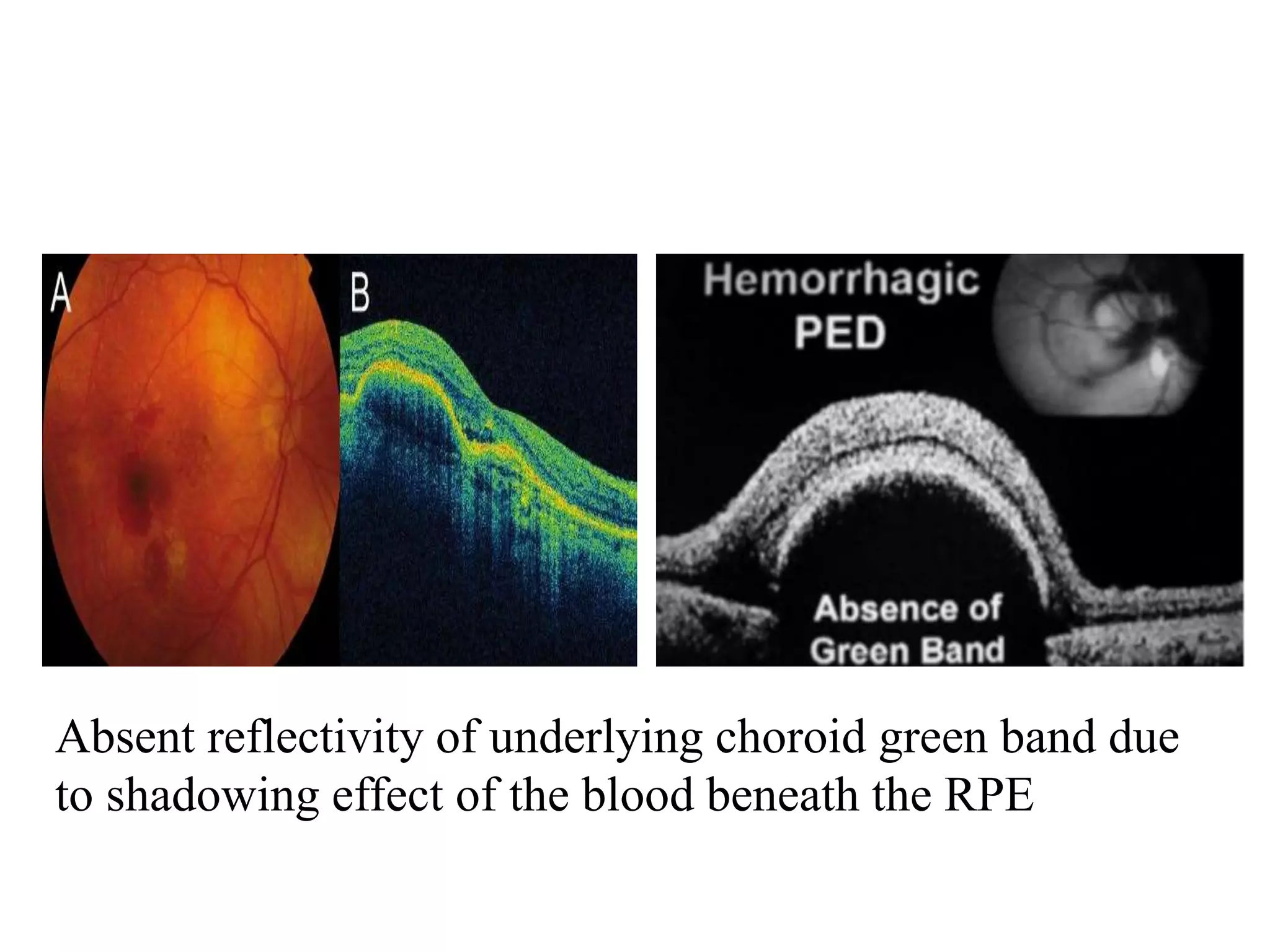 Pigment epithelial detachment (PED) | PPTX