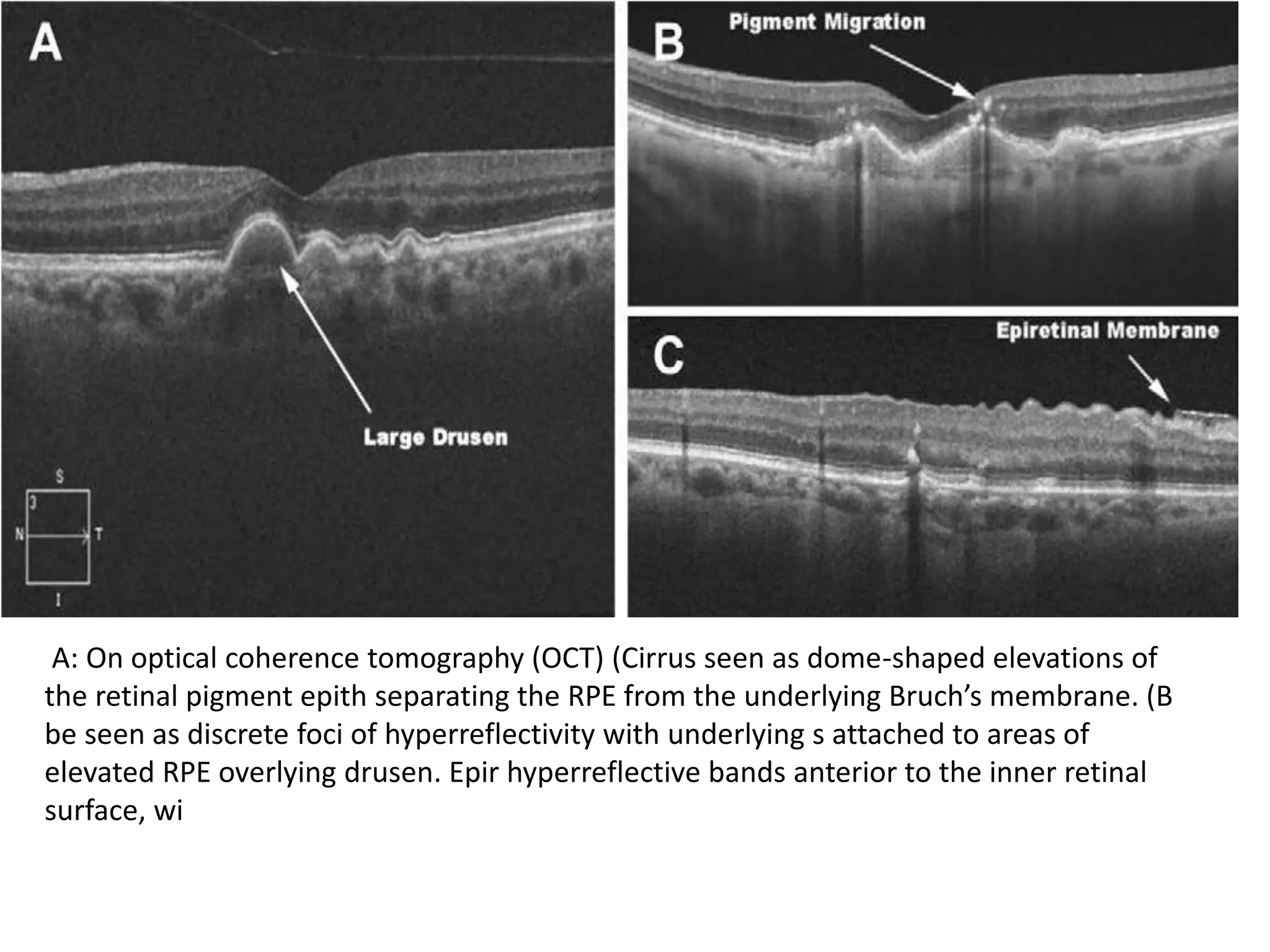Pigment epithelial detachment (PED) | PPTX