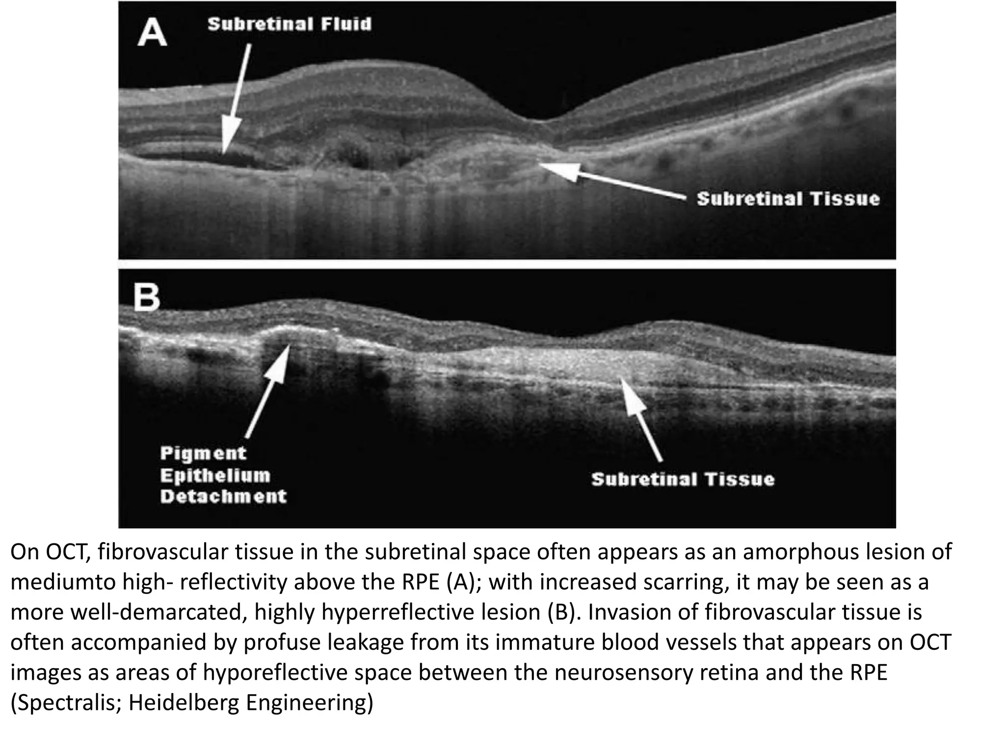 Pigment epithelial detachment (PED) | PPTX