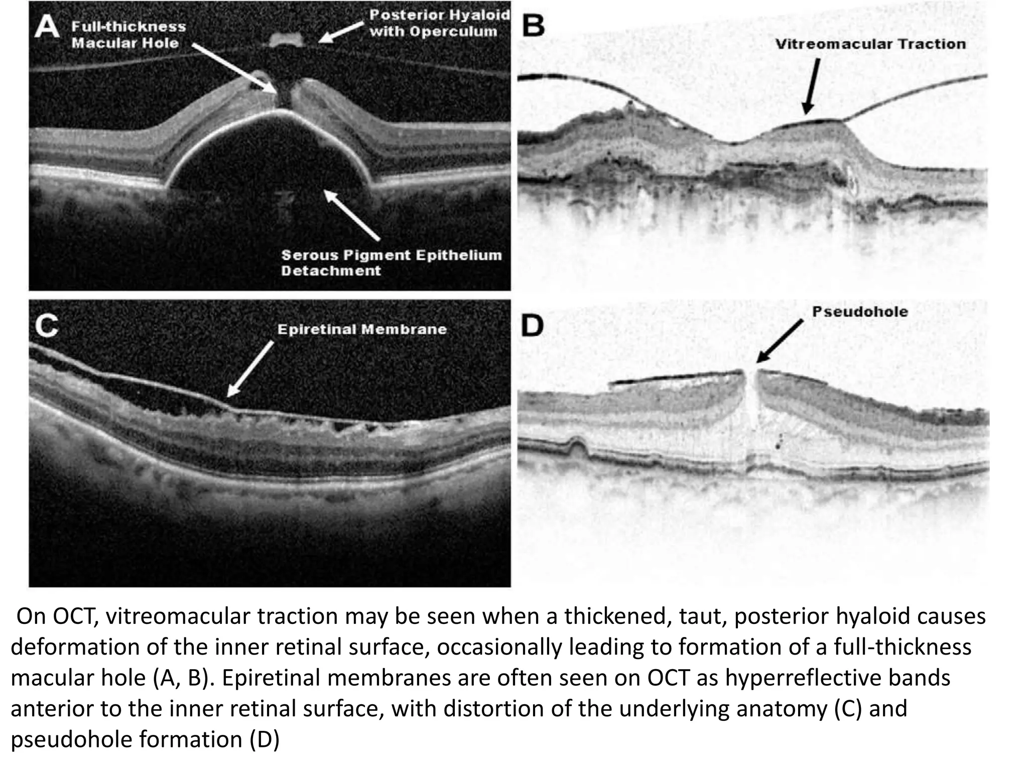 Pigment epithelial detachment (PED) | PPTX
