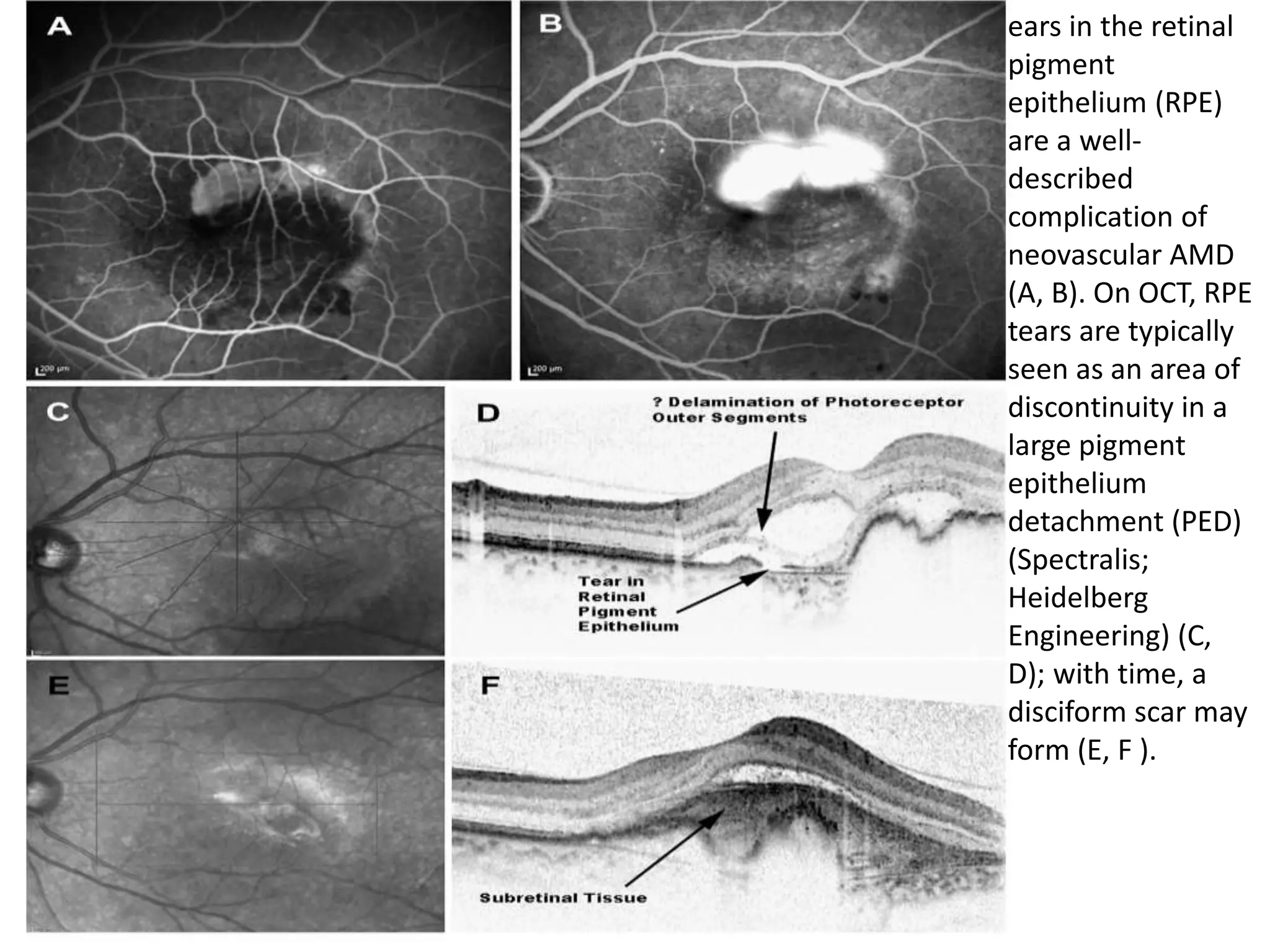 Pigment epithelial detachment (PED) | PPTX