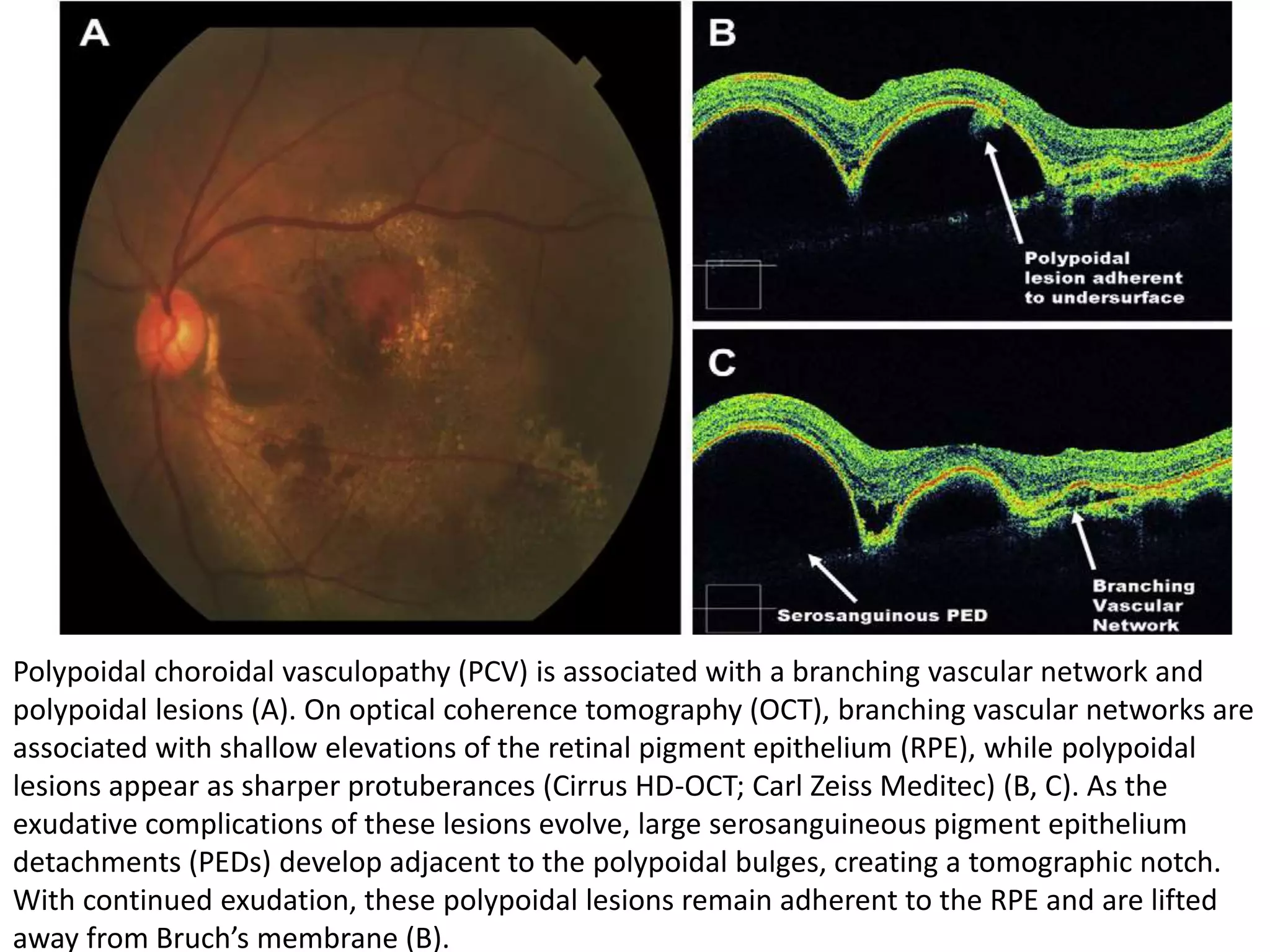 Pigment epithelial detachment (PED) | PPTX