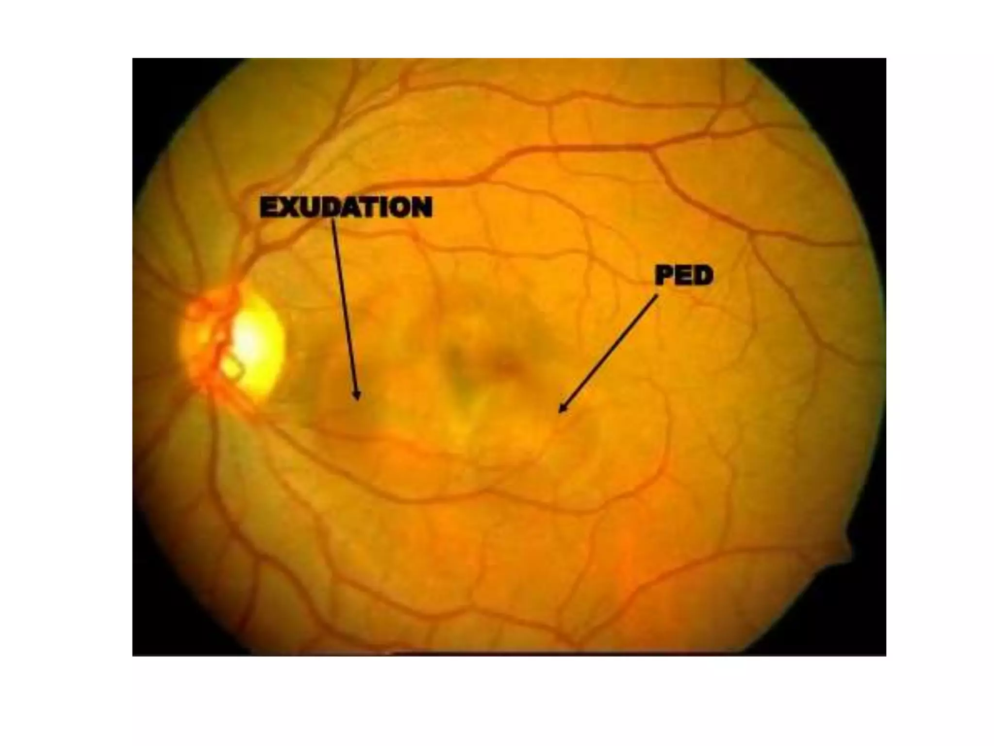 Pigment epithelial detachment (PED) | PPTX