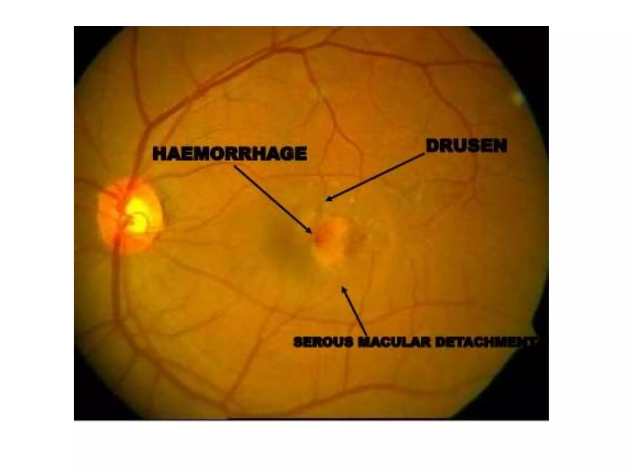Pigment epithelial detachment (PED) | PPTX