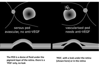 Pigment epithelial detachment (PED) | PPTX