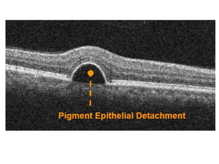 Pigment epithelial detachment (PED) | PPTX