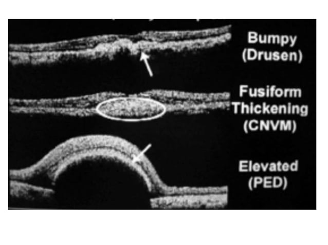 Pigment epithelial detachment (PED) | PPTX | Eye and Vision Conditions ...