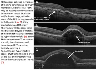 Pigment epithelial detachment (PED) | PPTX