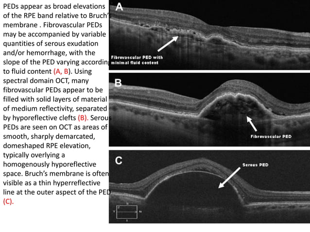 Pigment epithelial detachment (PED) | PPTX | Eye and Vision Conditions ...