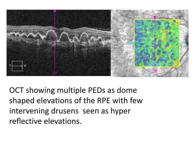 Pigment epithelial detachment (PED) | PPTX | Eye and Vision Conditions ...