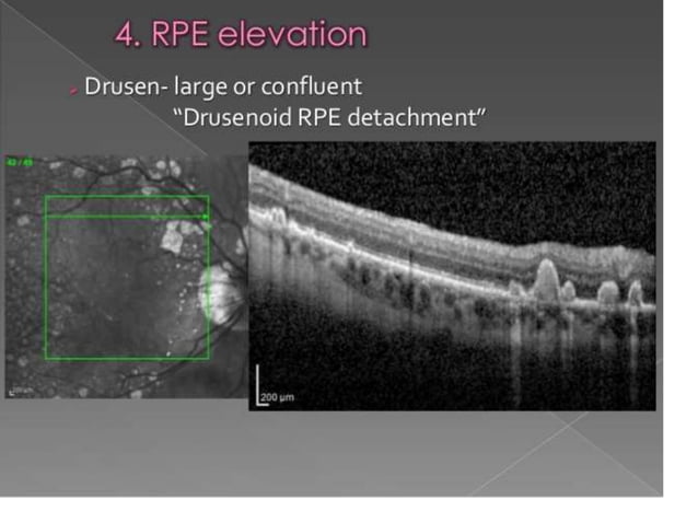 Pigment epithelial detachment (PED) | PPTX | Eye and Vision Conditions ...