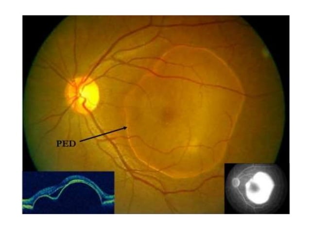 Pigment epithelial detachment (PED) | PPTX | Eye and Vision Conditions ...