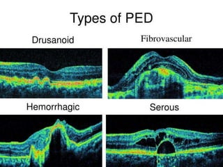 Drusenoid Pigment Epithelial Detachment