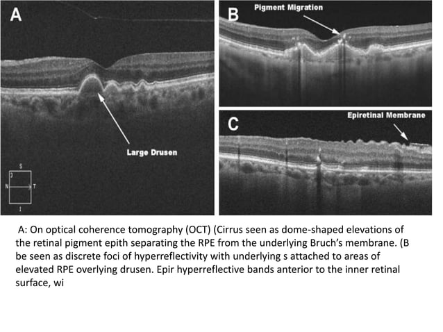 Pigment epithelial detachment (PED)