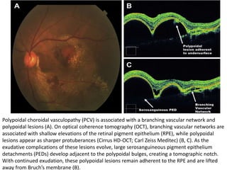 Pigment Epithelial Detachment