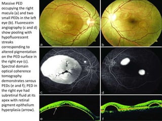 Drusenoid Pigment Epithelial Detachment