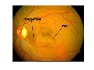 Pigment Epithelial Detachment (ped)