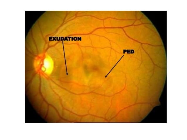 Pigment epithelial detachment (PED)