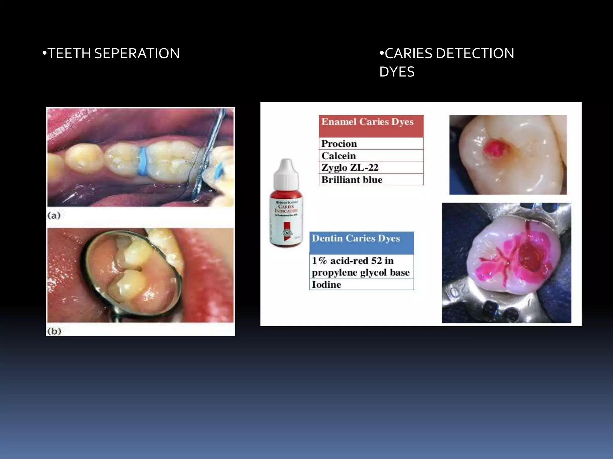 Diagnosis of dental caries | PPTX