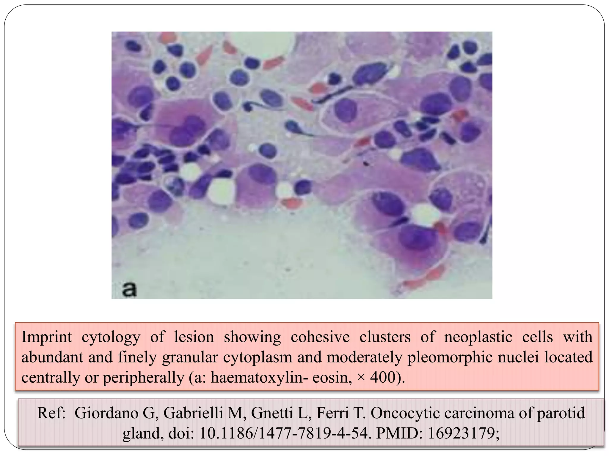 Oncocyte in salivary gland.pptx
