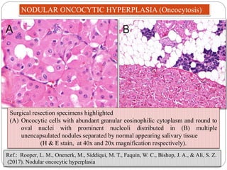 Oncocyte in salivary gland.pptx