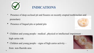 pedagogy 2- PIT AND FISSURE SEALANTS PEDAGOGY (1).pptx