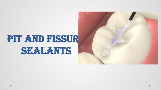 pedagogy 2- PIT AND FISSURE SEALANTS PEDAGOGY (1).pptx