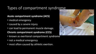 COMPARTMENT SYNDROME | PPTX