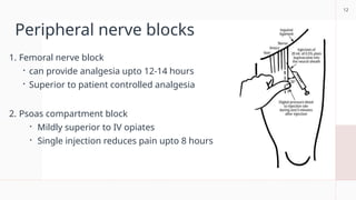 PAIN MANAGEMENT IN TOTAL HIP JOINT REPLACEMENT | PPT