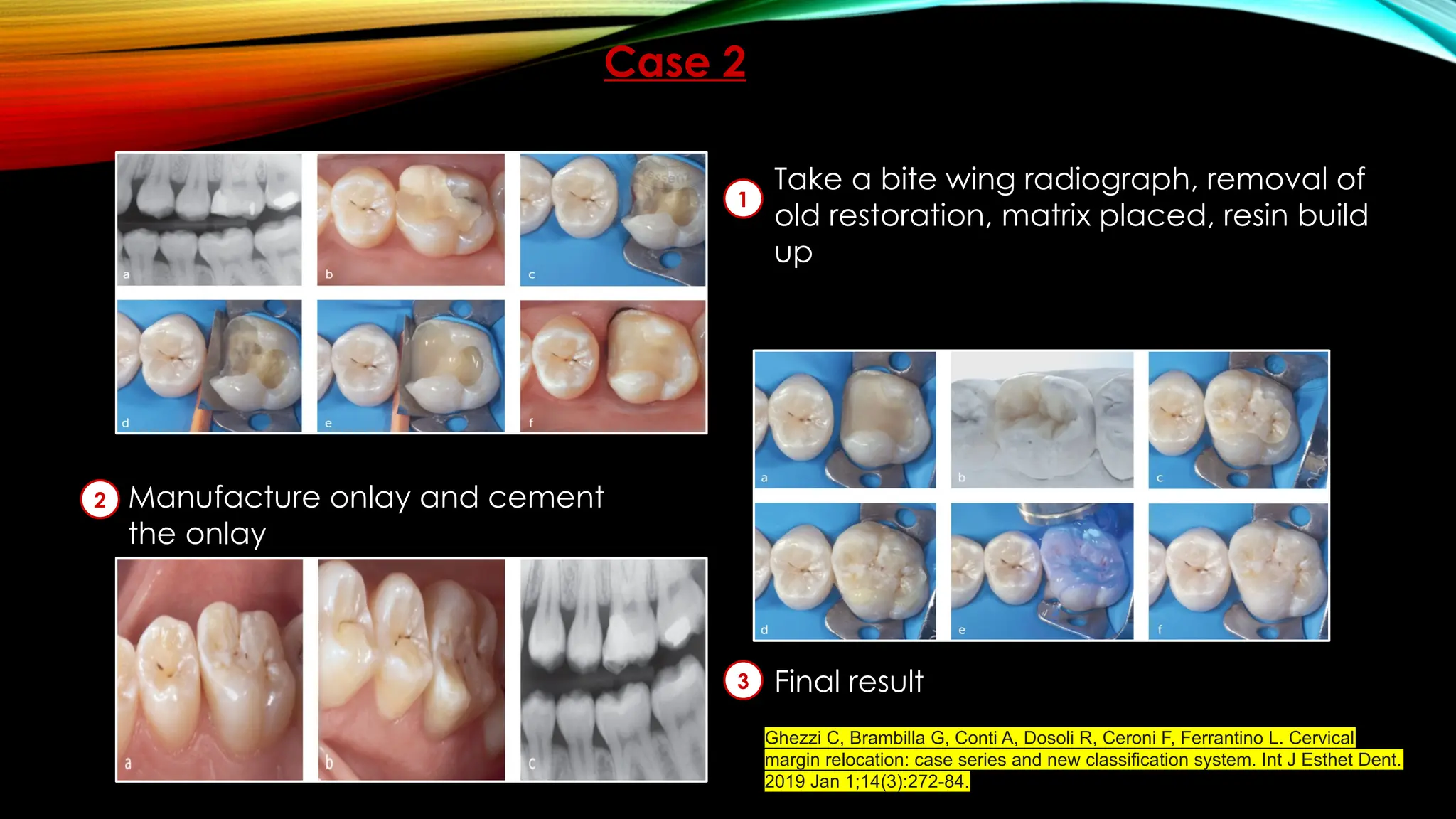 PEDAGOGY on DEEP MARGIN ELEVATION. Cons and endo pptx | PPTX