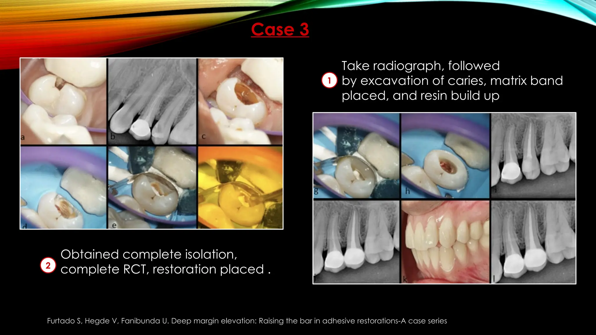 PEDAGOGY on DEEP MARGIN ELEVATION. Cons and endo pptx | PPTX