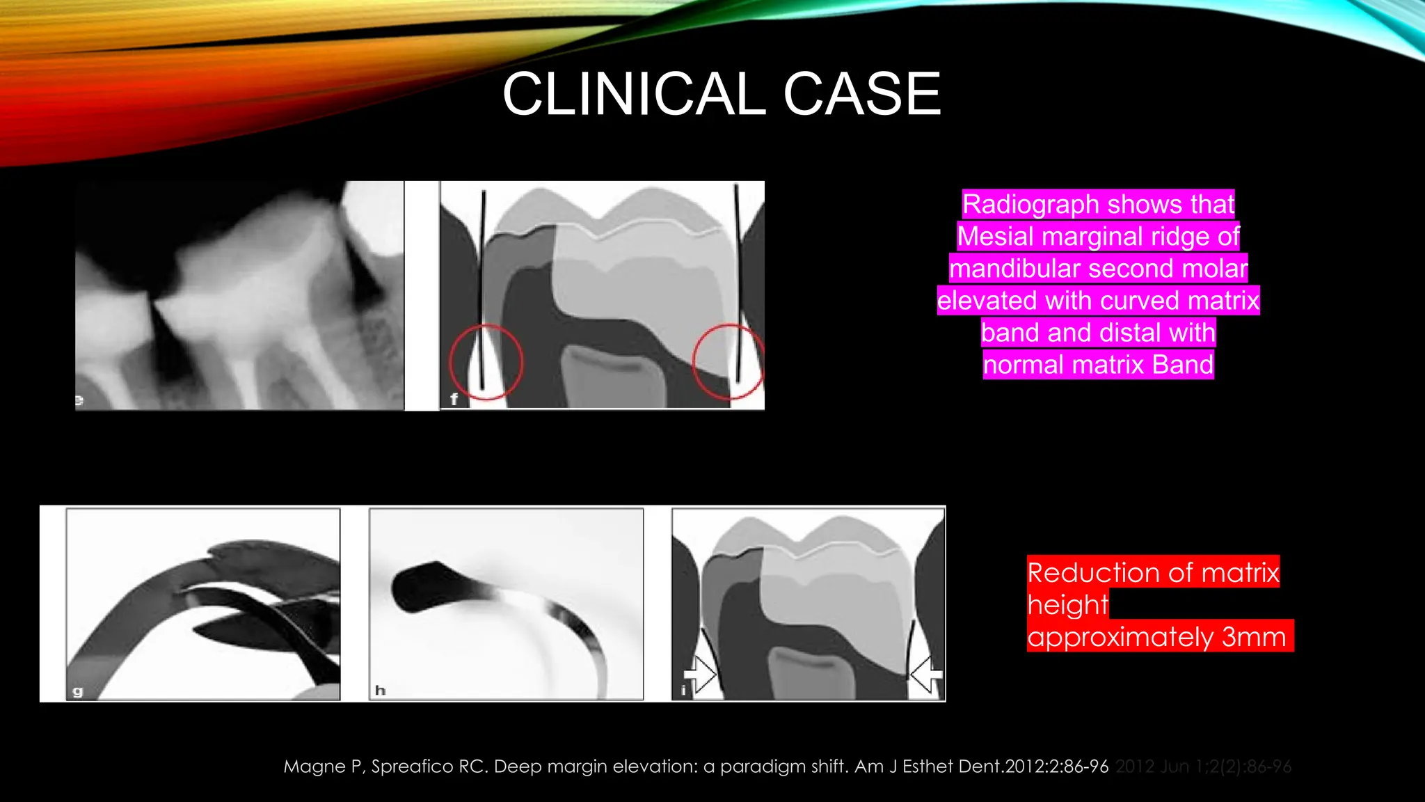 PEDAGOGY on DEEP MARGIN ELEVATION. Cons and endo pptx | PPTX