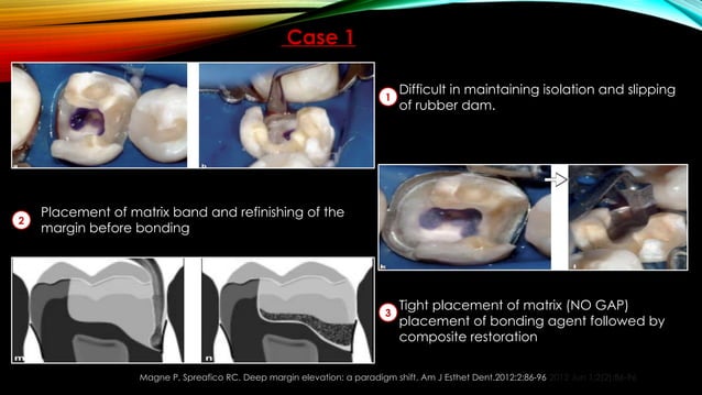 PEDAGOGY on DEEP MARGIN ELEVATION. Cons and endo pptx | PPTX
