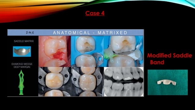 PEDAGOGY on DEEP MARGIN ELEVATION. Cons and endo pptx | PPTX