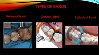 PEDAGOGY on DEEP MARGIN ELEVATION. Cons and endo pptx | PPTX
