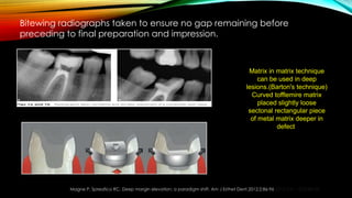 PEDAGOGY on DEEP MARGIN ELEVATION. Cons and endo pptx | PPTX