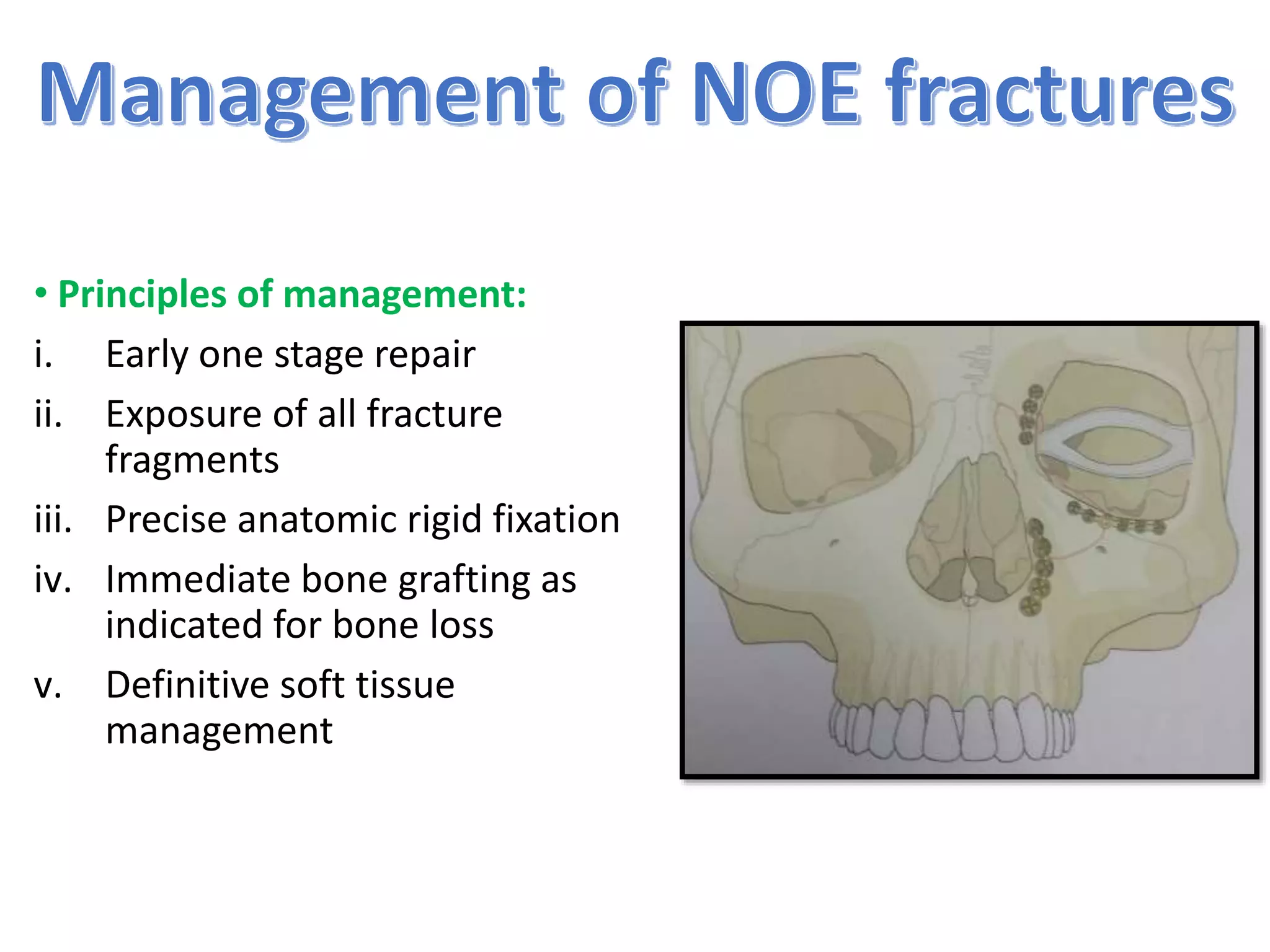 Naso-orbital-ethmoid (NOE) fractures: Management principles, options ...